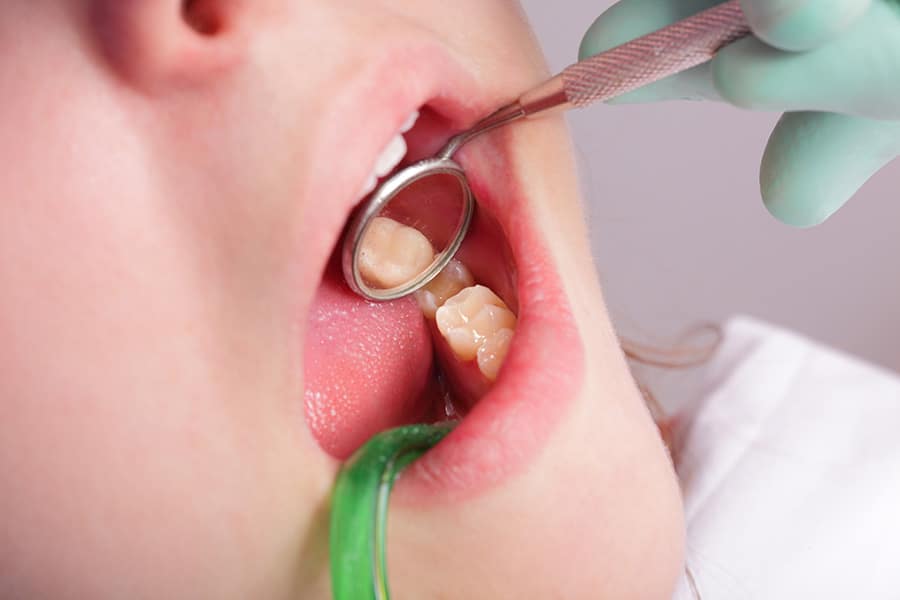 How Long Do Dental Fillings Last Evdp